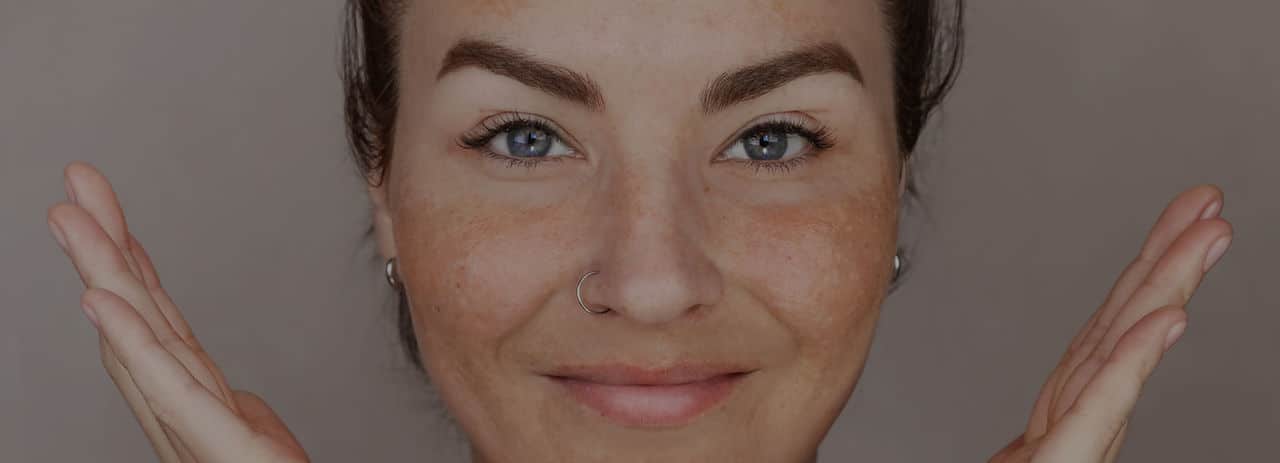 Sun Damage & Rosacea Treatment - Forever Young Elm Grove, WI